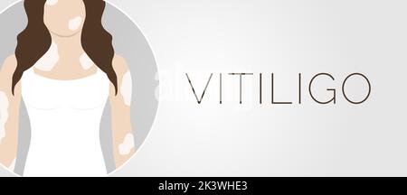 Vitiligo skin simple vector banner, poster, background. Person with ...