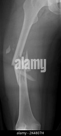 Fractured femur, X-ray Stock Photo - Alamy