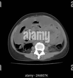 Ascites, CT scan Stock Photo - Alamy