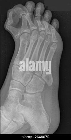 Polydactyly, Extra Toes, X-Ray Stock Photo - Alamy