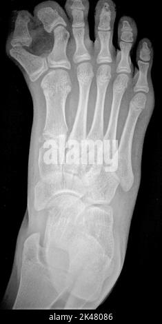 Polydactyly, Extra Toes, X-Ray Stock Photo - Alamy