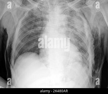 Subcutaneous Emphysema X Ray