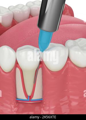 3d model teeth anesthesia Stock Photo - Alamy