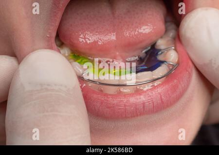 The orthodontist puts a plate on the lower teeth, a visit to the ...