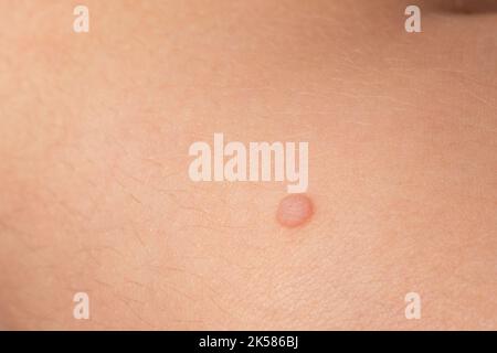 Common wart Verruca vulgaris on the skin of a child, papillomavirus in ...