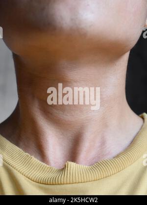 Neck swelling diagnosed as hyperthyroidism. Aging skin folds or skin ...