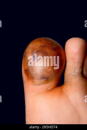 Abscess with surrounding cellulitis or Staphylococcal, Streptococcal ...