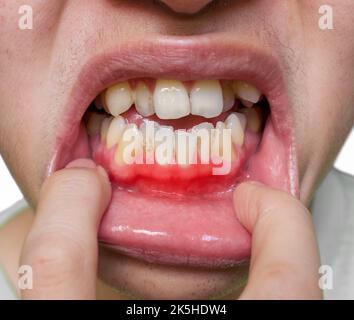 Inflammation of gum called gingivitis. Periodontal problem. Poor oral ...