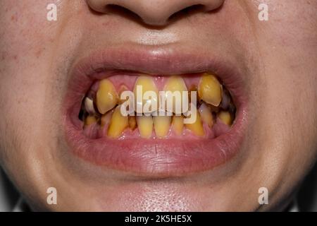 Crowded teeth with yellow colored tobacco stains. Poor oral hygiene ...