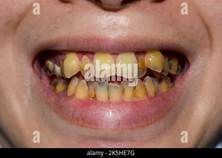 Crowded teeth with yellow colored tobacco stains. Poor oral hygiene ...