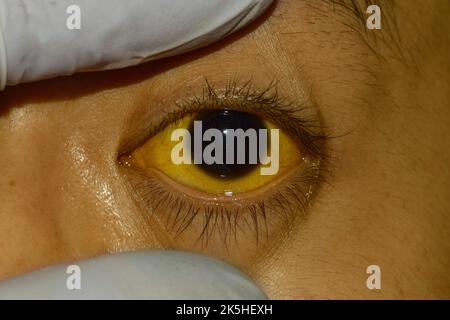 Deep jaundice in Asian male patient. Yellowish discoloration of skin ...