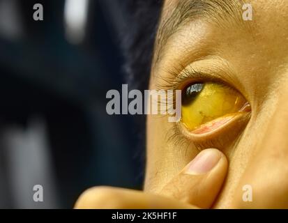 Deep jaundice in Asian male patient. Yellowish discoloration of skin ...