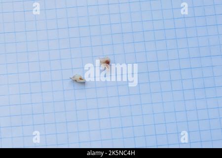 tooth decay. badly decayed extracted teeth Stock Photo - Alamy