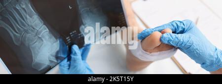 Doctor holds x-ray of foot and anatomy of bones of leg Stock Photo - Alamy