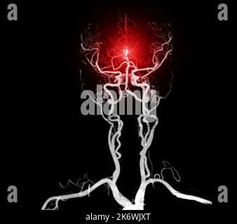 CTA brain or CT angiography of the brain 3D Rendering image for ...