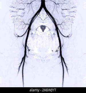 Femoral Angiogram of femoral artery showing femoral artery vessel ...