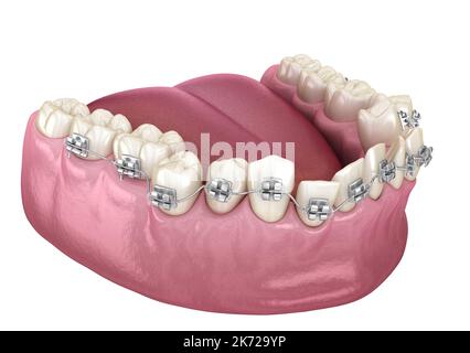 Abnormal teeth position and Clear braces tretament. Medically accurate ...