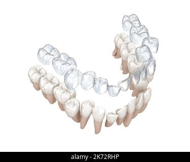 Invisalign braces or invisible retainer. Medically accurate dental 3D ...