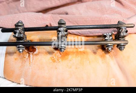 top view of external fixation device on hip and pelvic in patient with ...