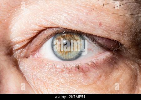 Close-up of a chalazion (meibomian cyst, white) in the lower eyelid of ...