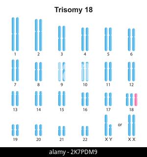 Scientific Designing of Edwards Syndrome (Trisomy 18). Colorful Symbols ...