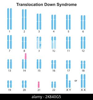 Symptoms of down syndrome vector infographic poster Stock Vector Image & Art - Alamy