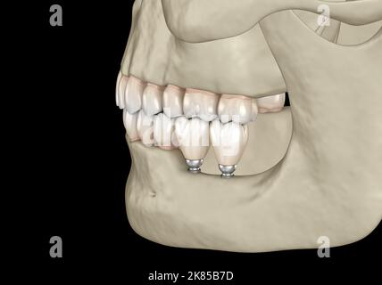 Implantation with mini implants in to recessed jaw bone: Medically ...