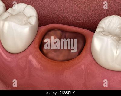 The blood clot seals off the tooth after extraction. Medically accurate ...