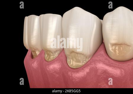 Abfraction of anterior teeth. Medically accurate 3D illustration Stock ...