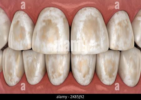 Tooth demineralization, removal of minerals from hard tissues: enamel ...
