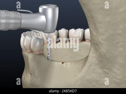 Cleavage of the alveolar ridge : implantation. Dental surgery, 3D ...