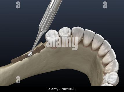 Cleavage of the alveolar ridge : implantation. Dental surgery, 3D ...