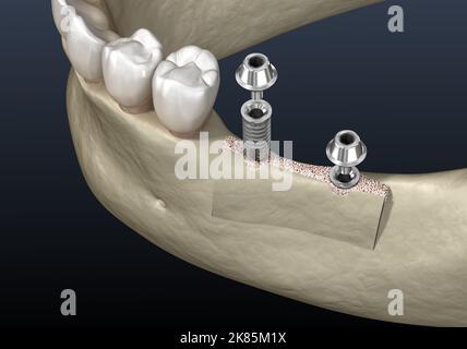 Cleavage of the alveolar ridge, augmentation. Dental surgery, 3D ...