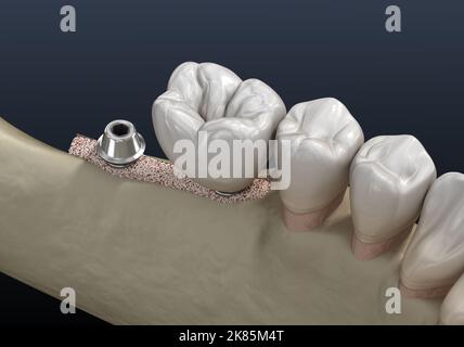 Cleavage of the alveolar ridge : implantation. Dental surgery, 3D ...