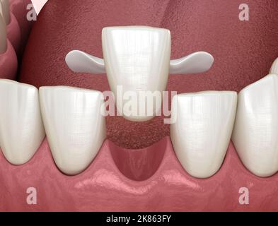 Maryland bridge made from ceramic, premolar tooth recovery. Medically ...