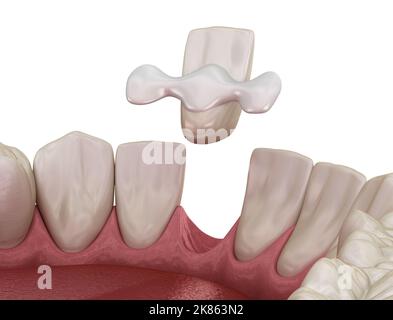Maryland bridge made from ceramic, premolar tooth recovery. Medically ...
