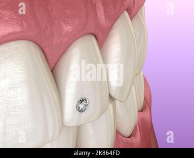 Tooth piercing by diamond, 3D illustration concept Stock Photo - Alamy