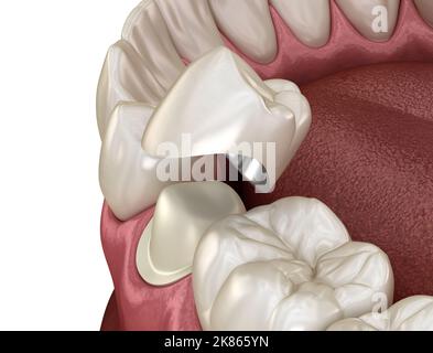 Premolar and Molar tooth crown installation over implant, screw ...