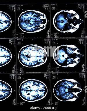 A MRI brain scans of a patient with Multiple Sclerosis Stock Photo - Alamy