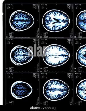 A MRI brain scans of a patient with Multiple Sclerosis Stock Photo - Alamy