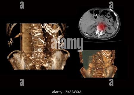 computed tomography of the spine with a fracture of the vertebrae and ...
