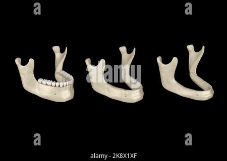 Mandibular Jaw, bone recession after losing molars teeth. Medically ...