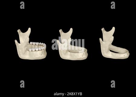 Mandibular Jaw, bone recession after losing teeth. Medically accurate ...