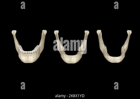 Mandibular Jaw, bone recession after losing molars teeth. Medically ...