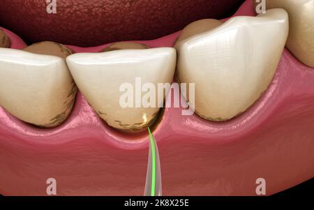 Laser removes a thin layer of infected skin, teeth cleaning. Medically ...