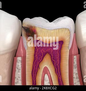Hidden caries in to molar tooth. Medically accurate 3D illustration ...