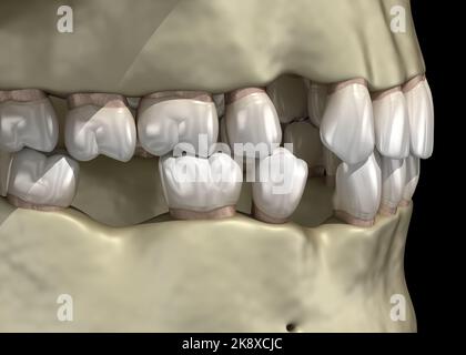 Teeth shift deformatiuon after losing molar tooth. 3D illustration of ...