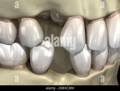 Teeth shift deformatiuon after losing molar tooth. 3D illustration of ...