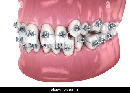Abnormal teeth position and correction with metal braces tretament ...