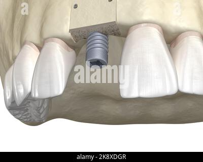 Bone grafting- augmentation using block of bone, tooth implantation ...